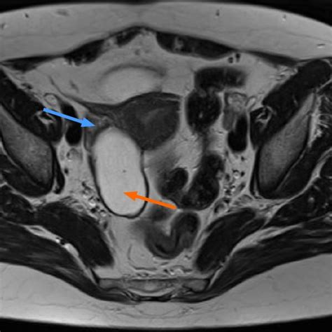 Low Grade Mucinous Appendiceal Neoplasm Mimicking An Ovarian Tumor Download Scientific Diagram