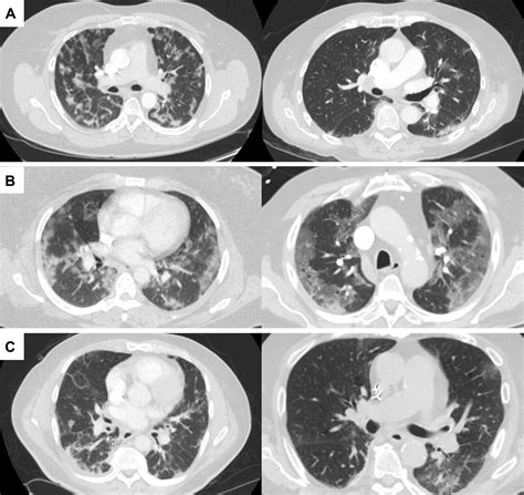 Rate Of True Positive Findings Of Covid Typical Appearance At Chest