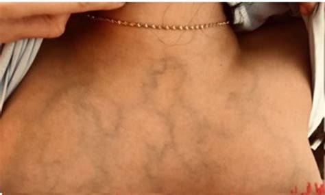 Young Patient With Periumbilical Pain Emergency Medicine Journal