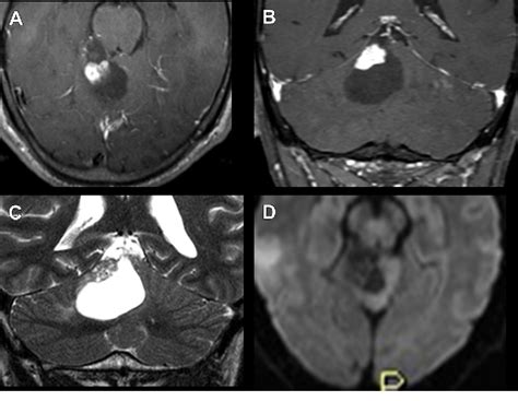 Figure 15 From Multiparametric Mr Imaging In The Assessment Of Brain