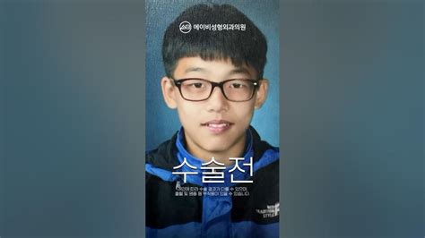 남자눈매교정코수술윤곽3종 후기 Shorts Youtube