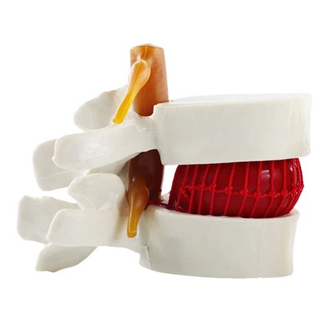 Intervertebral Disc Model Pvc Spine Skeleton Lumbar For Demonstrating