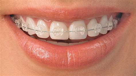 Clear Outside Braces Faqs Smiles And Faces Orthodontics