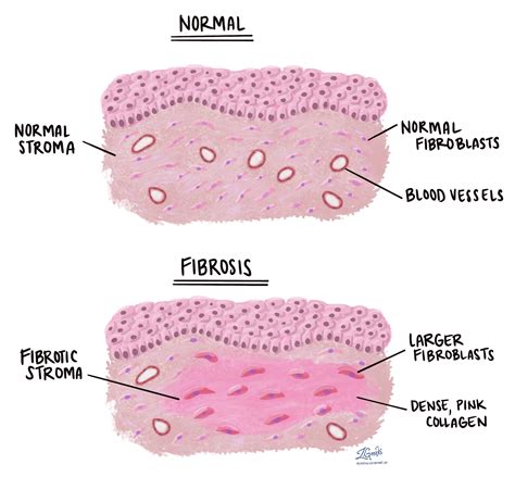 Fibrosis Mypathologyreport