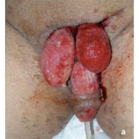A Granulation Tissue After Debridement And Local Care B Download Scientific Diagram