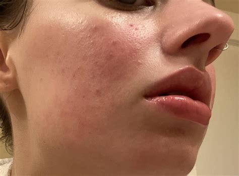 Type 2 Rosacea Going To New Dermatologist Next Week Rrosacea