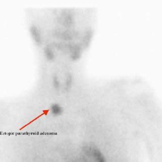 PDF Primary Hyperparathyroidism Jaw Tumor Syndrome A Confusing And Forgotten Diagnosis
