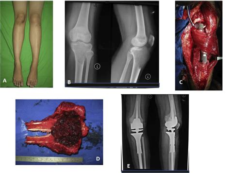 Figure 2 From Outcomes Of En Bloc Resection Followed By Reconstruction Of Giant Cell Tumor