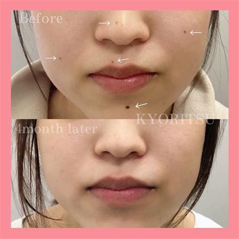 ほくろ除去 症例写真｜美容整形、美容医療専門クリニック