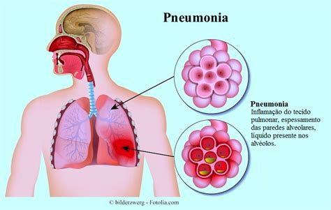 Saúde do Adulto Pneumonia