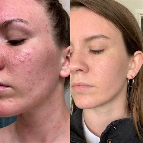 Mild Atopic Dermatitis Face