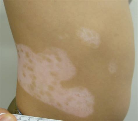 Vitiligo Photo Gallery Global Vitiligo Foundation