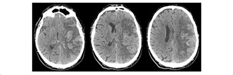 Massive Cortical Hemorrhage With Mass Effect Mostly Caused By The