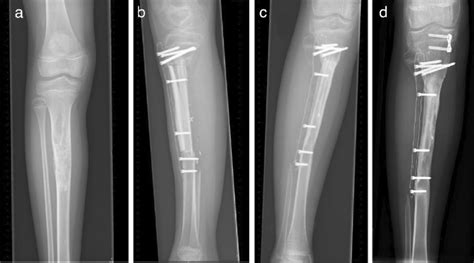 Adamantinoma In The Proximal Tibia Of A 10 Year Old Girl A Status