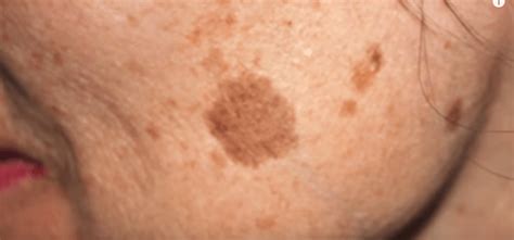 Simple Trick To Remove Brown Spots From Your Skin Tiphero