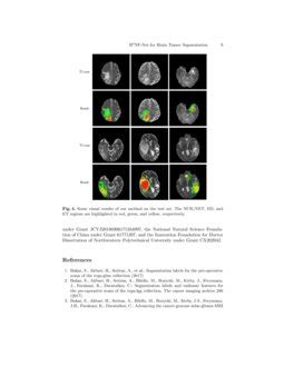 H2NF Net For Brain Tumor Segmentation Using Multimodal MR Imaging 2nd