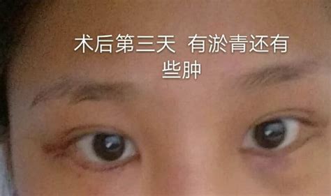 眶隔脂肪释放术无效果，怒怼眶隔脂肪释放术成功率低，句句在理~ 哔哩哔哩