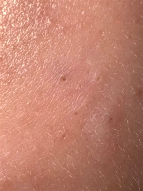 피부에 검은색 작은 점 지식in