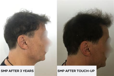 Scalp Micropigmentation Aftercare Ftg Clinics