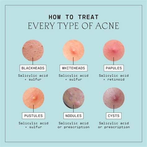 Types Of Acne Explained Types Of Acne Acne Skin Care Acne