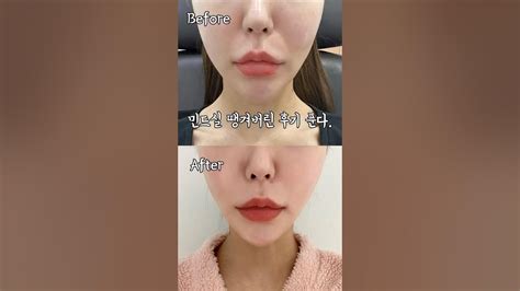 민트실 땡겨버린 후기 민트실리프팅 리프팅시술 실리프팅 리프팅레이저 실리프팅후기 실리프팅전후 실리프팅부작용 실리프팅잘하는곳 Youtube