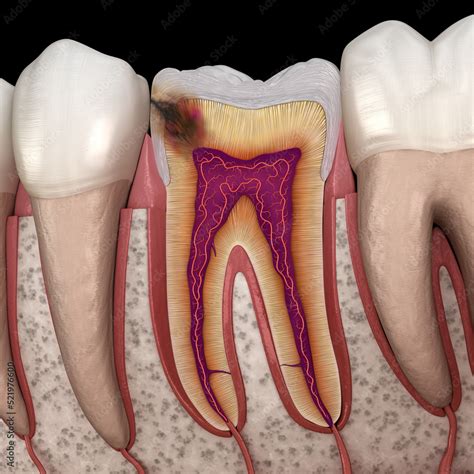 Hidden Caries In To Molar Tooth Medically Accurate 3d Illustration Ilustración De Stock Adobe