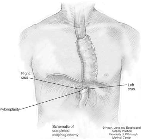 Cholecystojejunostomy And Choledocho Hepaticojejunostomy Basicmedical Key
