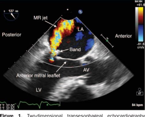 Figure 1 From Echo Rounds Intraoperative Delineation Of Mitral