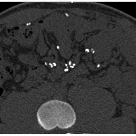 unenhanced ct scan showing multiple liver calcifications download