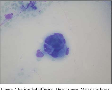 Figure 1 From Cytology Of Pericardial Effusion Due To Malignancy Semantic Scholar