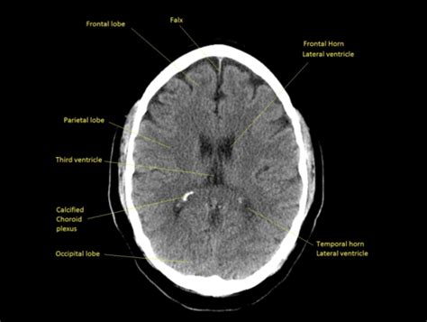 Clin Lab Neuro Msk Endocrine Flashcards Quizlet
