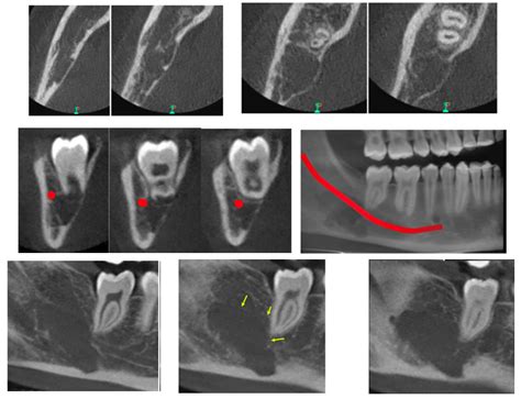 Simple Bone Cyst Mandible Simple Bone Cyst Mandible