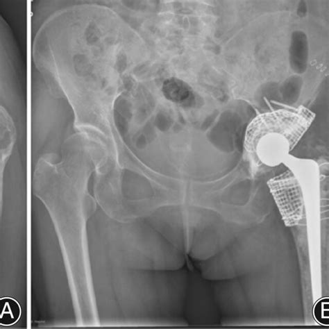 A C Preoperative And Follow‐up Radiographs Of The Left Hip Joint In A