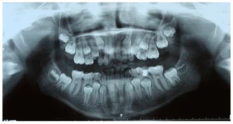 Orthodontic And Surgical Treatment Of Delayed Eruption Of Mandibular