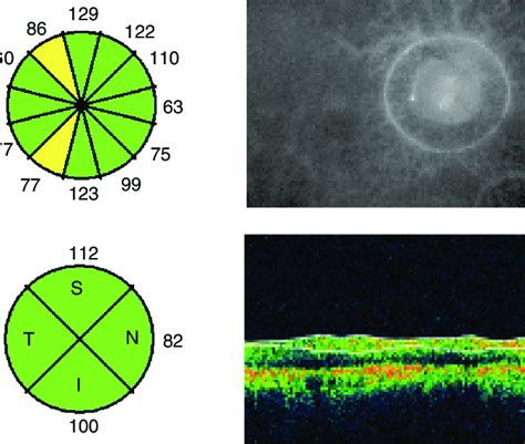 Quantitative Analysis Of Rnfl Thickness In A Patient Who Experienced An Download Scientific