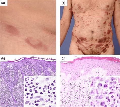 Representative Clinical And Histological Examples Of Cutaneous