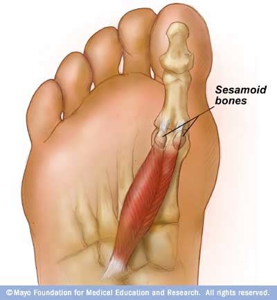 Sesamoid Bone Removal