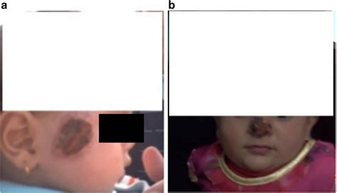 Cutaneous Leishmaniasis A Face And B Nose In Anbar Province Iraq Download Scientific Diagram