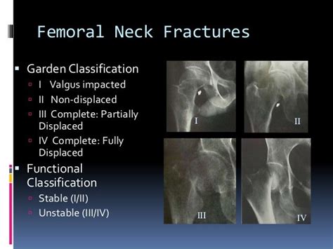 Hip Fracture Classification Acetabular Fracture Classification
