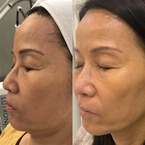 Infini Rf Microneedling The Grand Medical Aesthetic Clinic