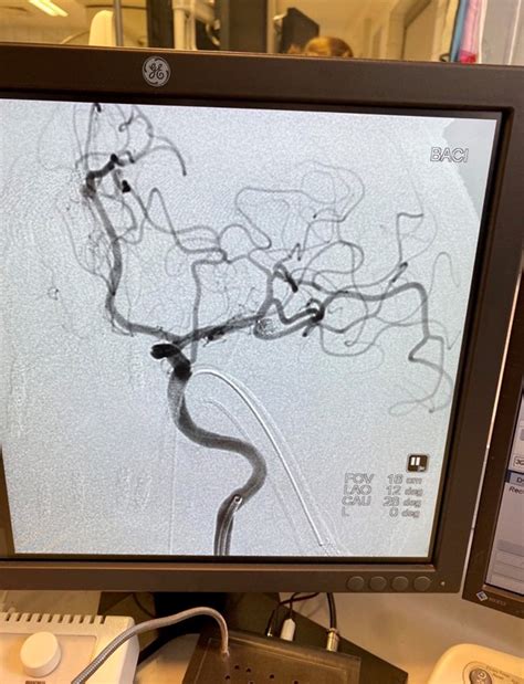 Successful Case With Penumbra Smart Coils Dhs Hungary