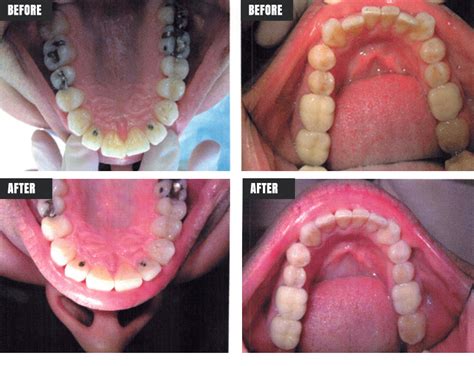 Invisalign Before And After Rose M Feliciano Dmd San Jose Dentist