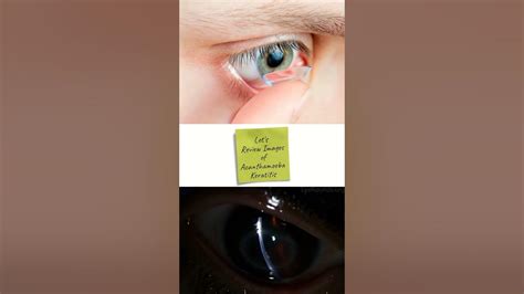 Acanthamoeba Keratitis Keratitis Eye Infection Caused By Free Living Amoebae Acanthamoeba