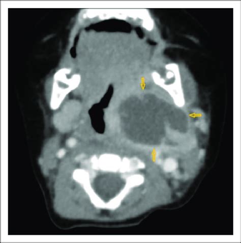 Parapharyngeal Abscess Ct Scan Axial Projection Download