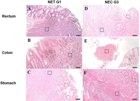 Representative Findings Of Tumor Solid Line And Adjacent Normal