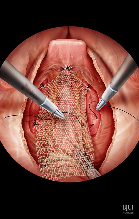 Laparoscopic Sacrocolpopexy