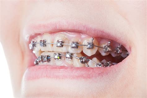 Cómo afecta la maloclusión dental a la salud Clínica Gramadent