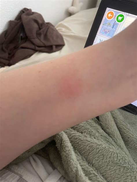 Bug Bites Simple Life Hacks Everyday Hacks Identifying Bug Bites Useful Life Hacks