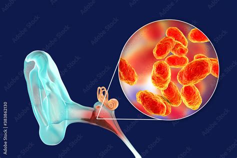 Otitis Media Inflammatory Disease Of The Middle Ear Stock Illustration