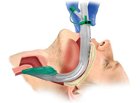 I Gel Supraglottic Airway News Dentagama
